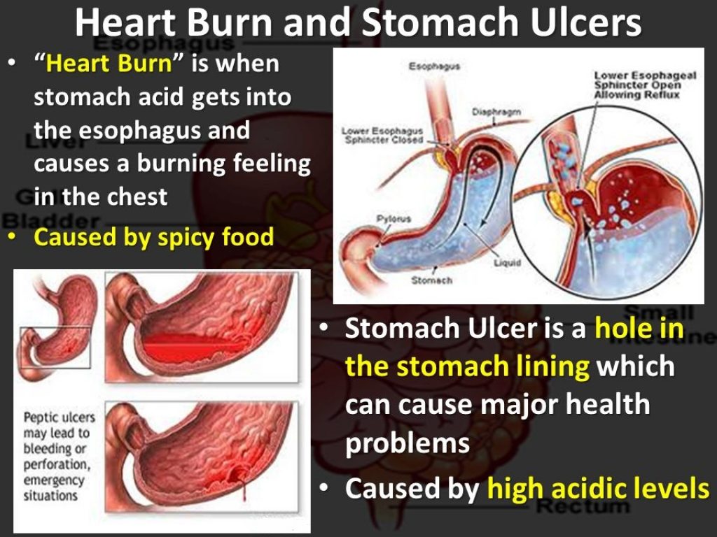 Dietary recommendations for patients with gastric ulcer